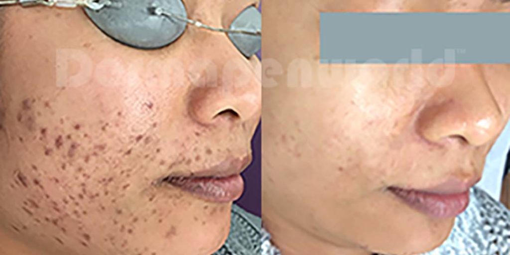 Dermapen - Acacia Skin Health & Beauty